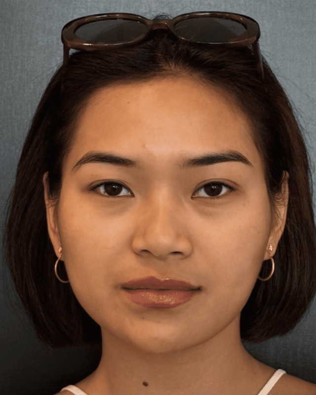 Injectable - MeSO Medspa