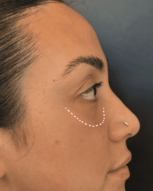 Rejuvenation Injection - MeSO Medspa